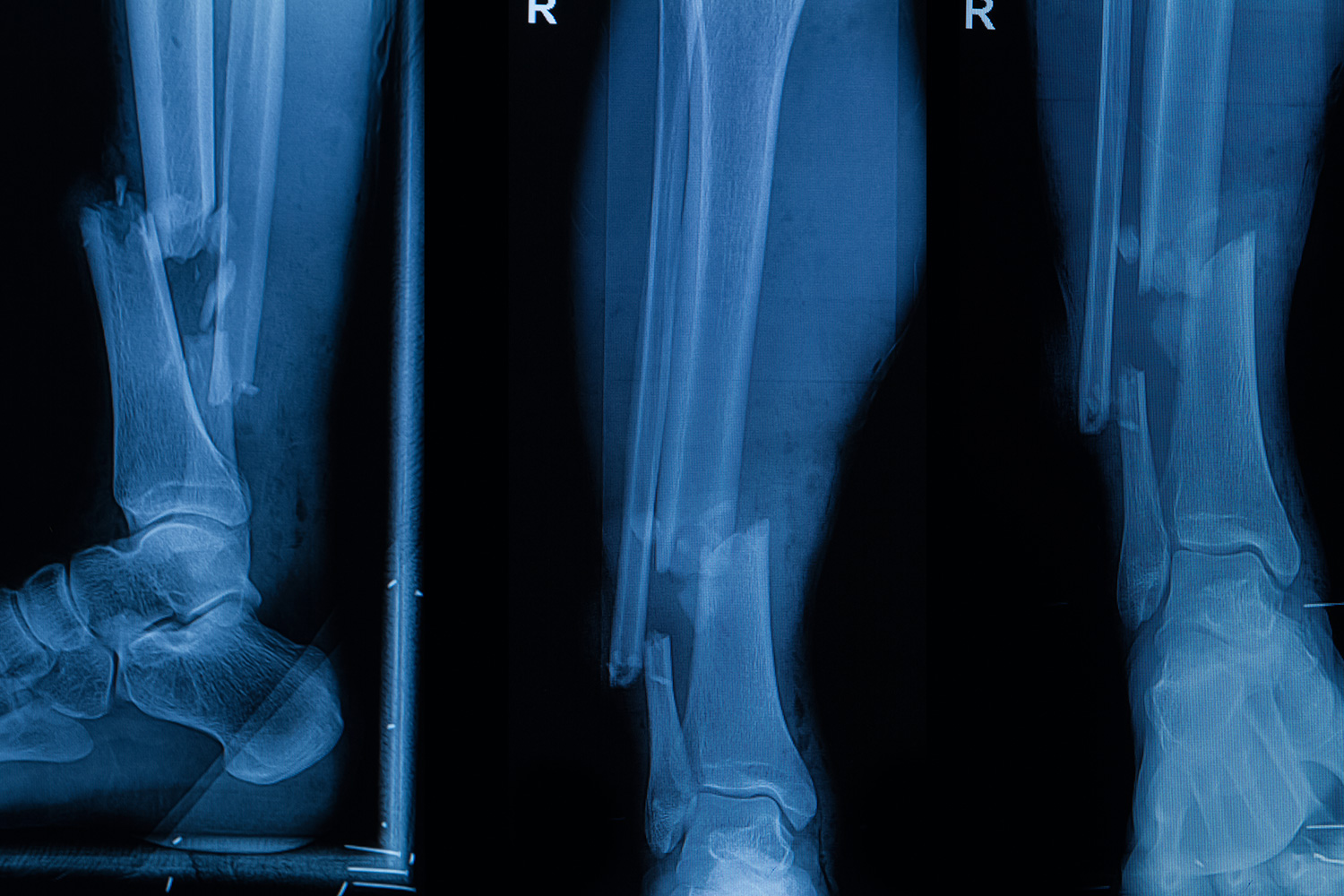 Tips to Help You Avoid Exercise Injury Emergencies - Angleton ER